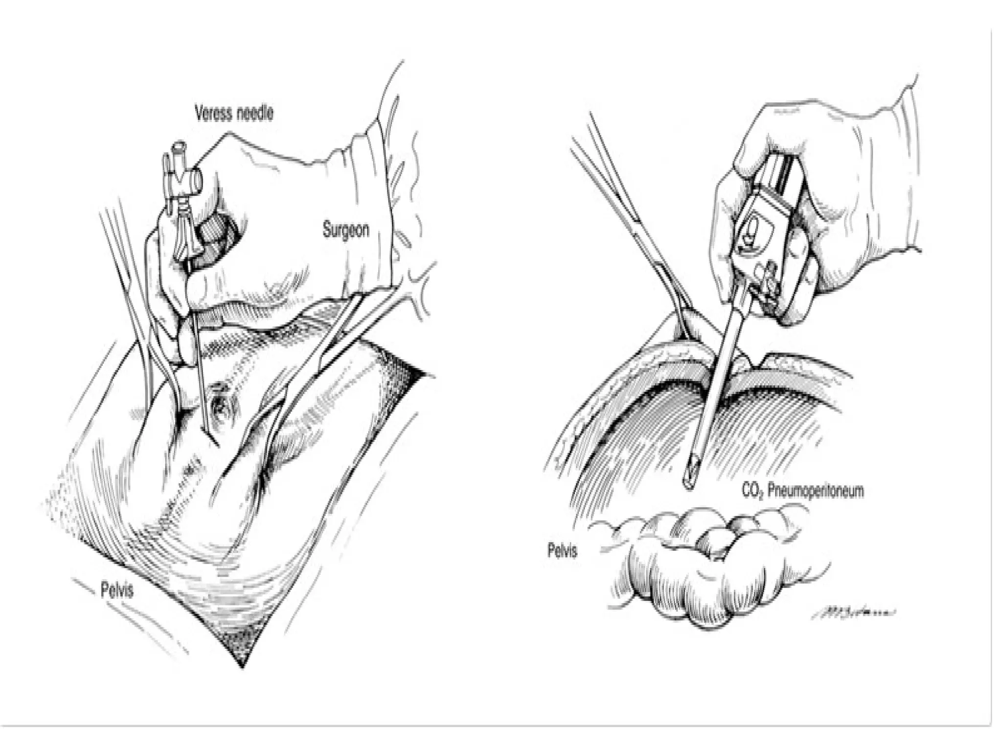 Creation of pneumoperitoneum in laparoscopic surgery | PPT
