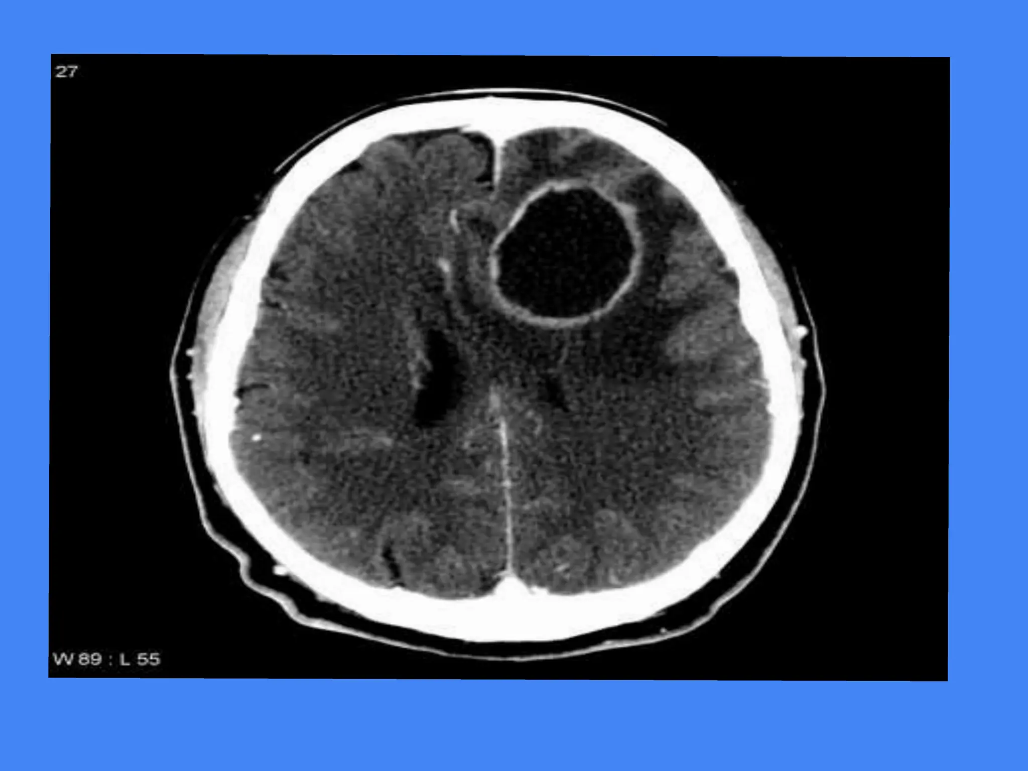 INTRACRANIAL ABSCESS | PPTX