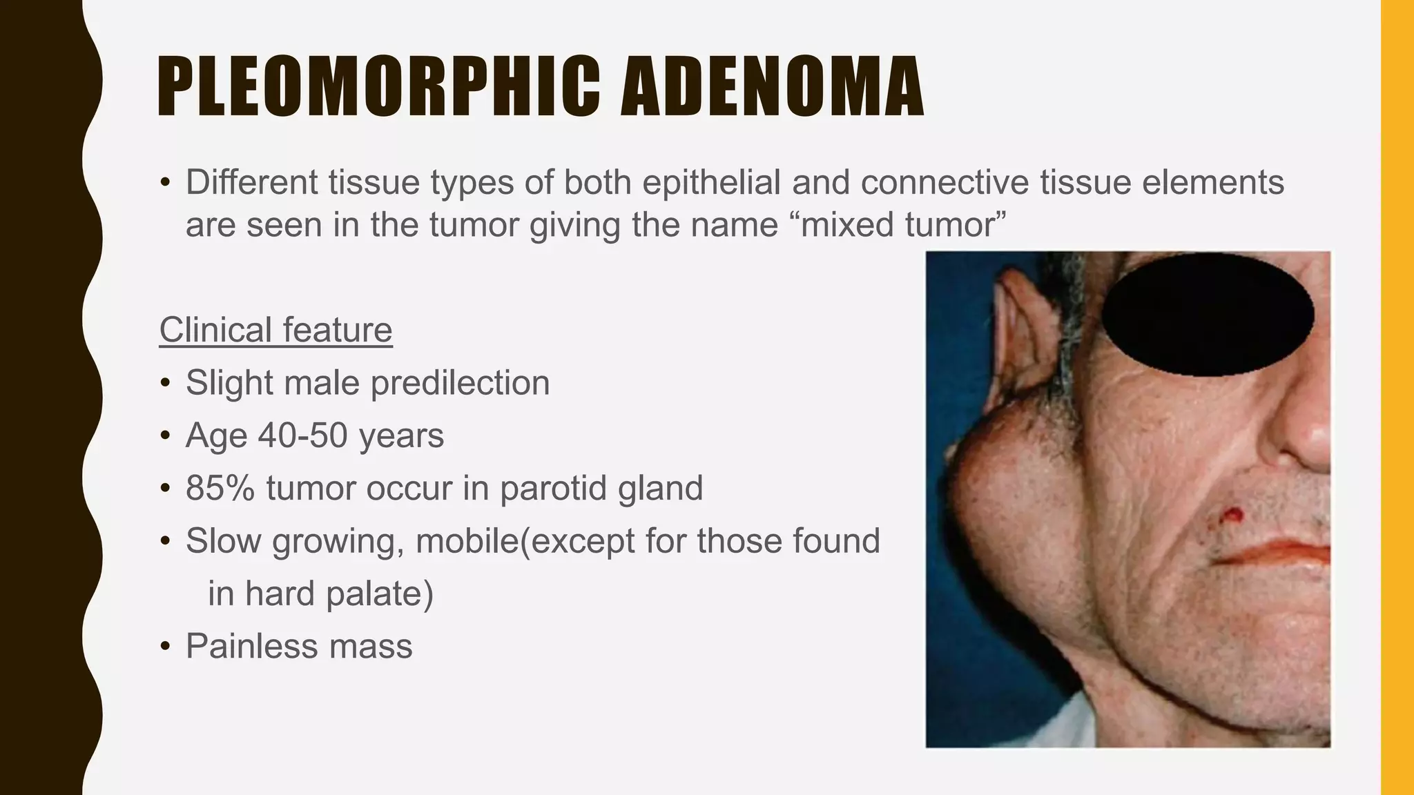Parotid gland swelling | PPTX