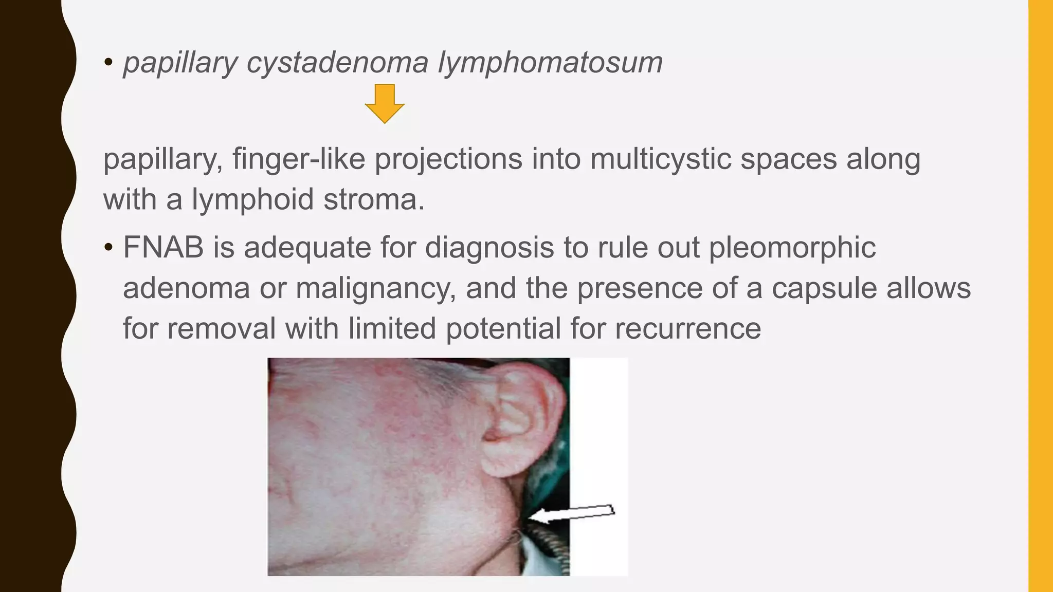 Parotid gland swelling | PPTX