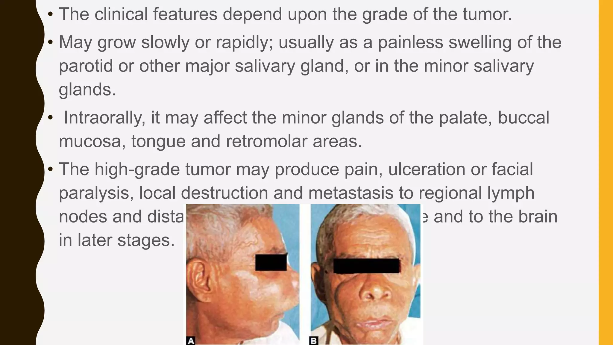 Parotid gland swelling | PPTX