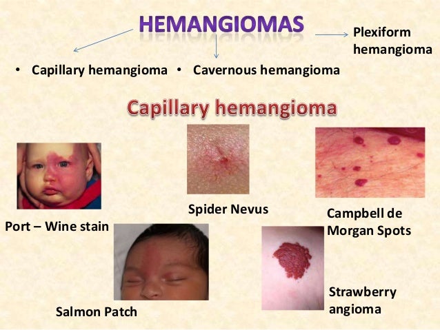Benign Skin Swellings