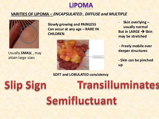 Benign Skin Swellings
