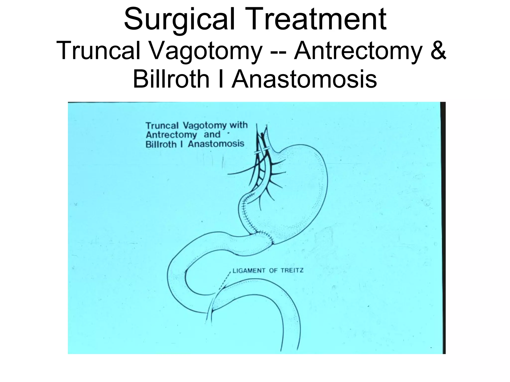Surgery Stomach & Duodenum Tg | PPT