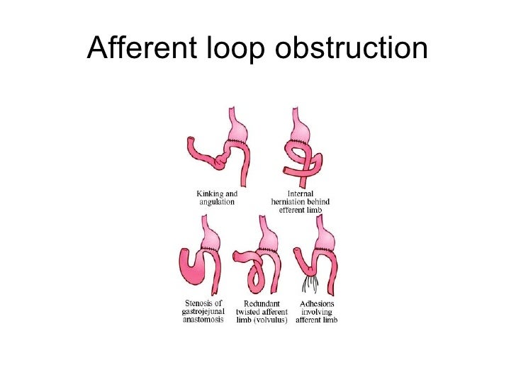 Surgery Stomach & Duodenum Tg