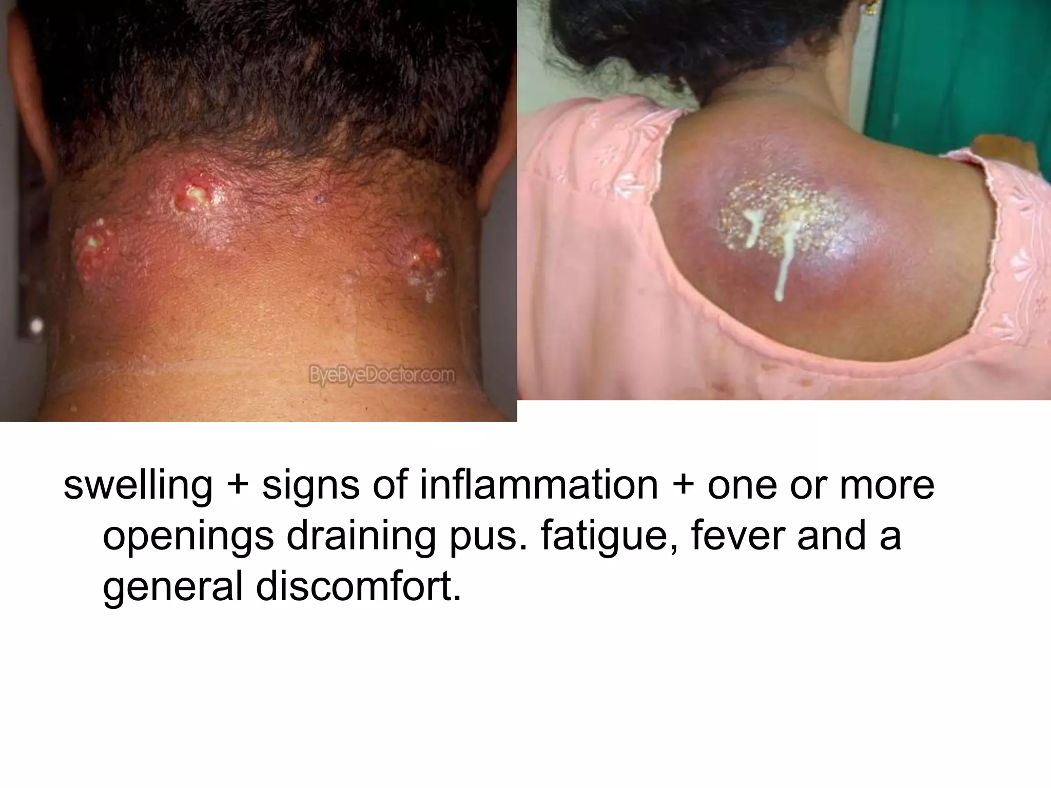 Surgery(surgical infections) 1-2 | PPT