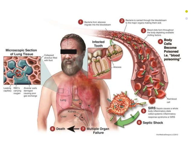 Surgery Surgical Infections 1 2 Ppt Infectious Diseases Diseases