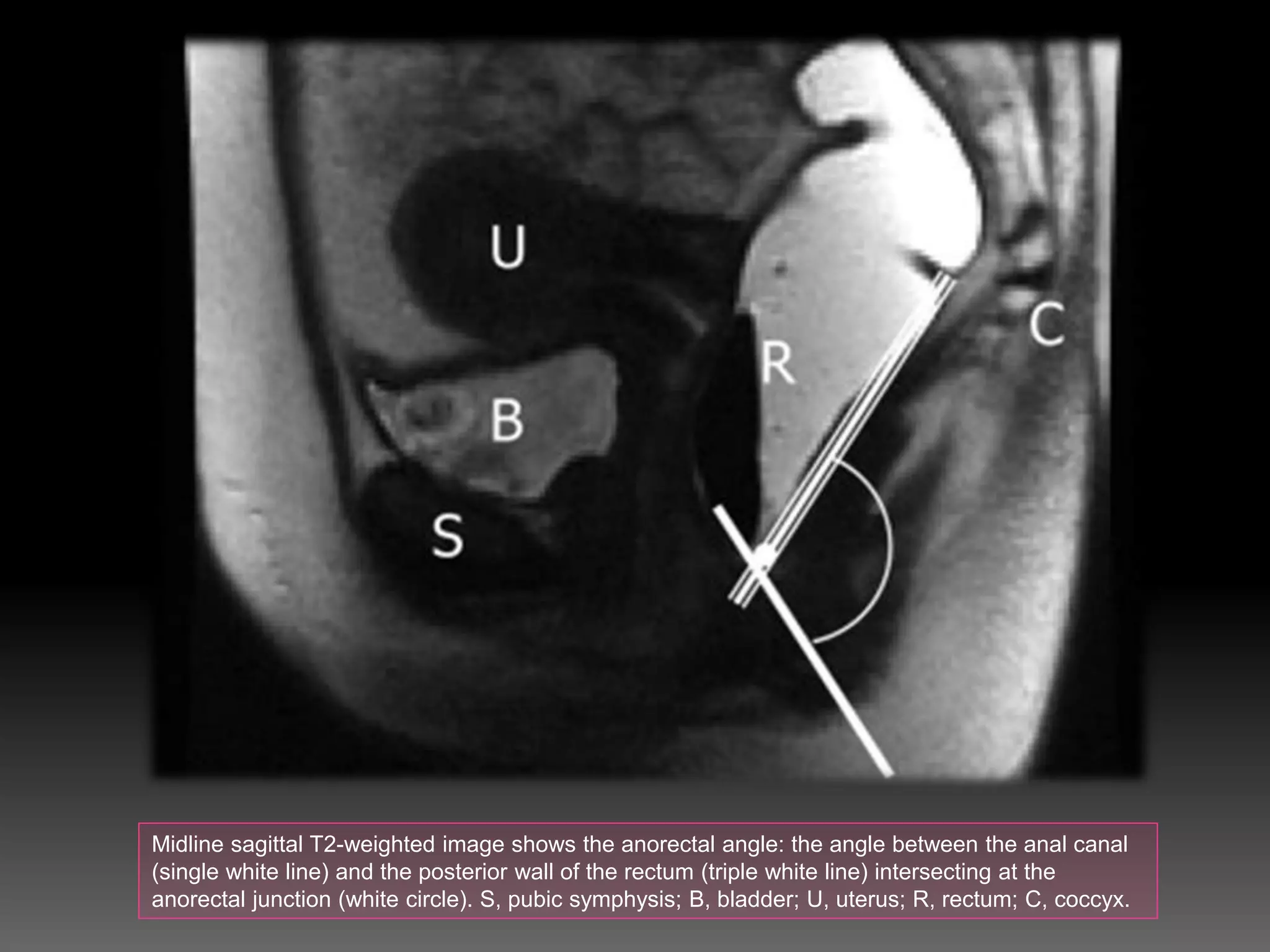 Anatomy&Physiology of Rectum | PPTX