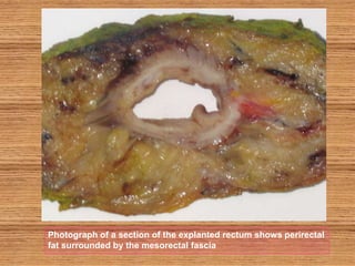 Anatomy&Physiology of Rectum | PPTX