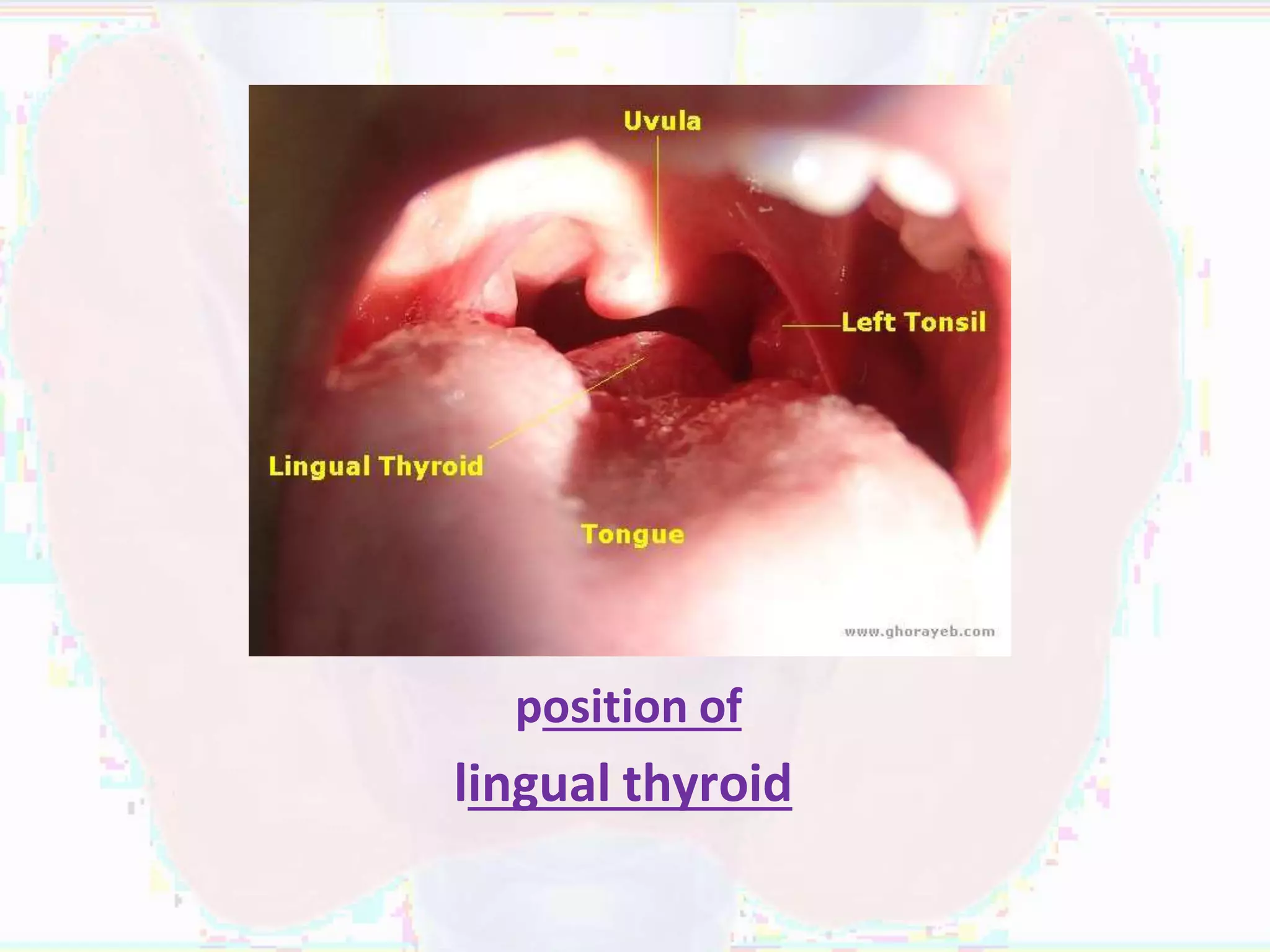 Surgery Thyroid.pptx