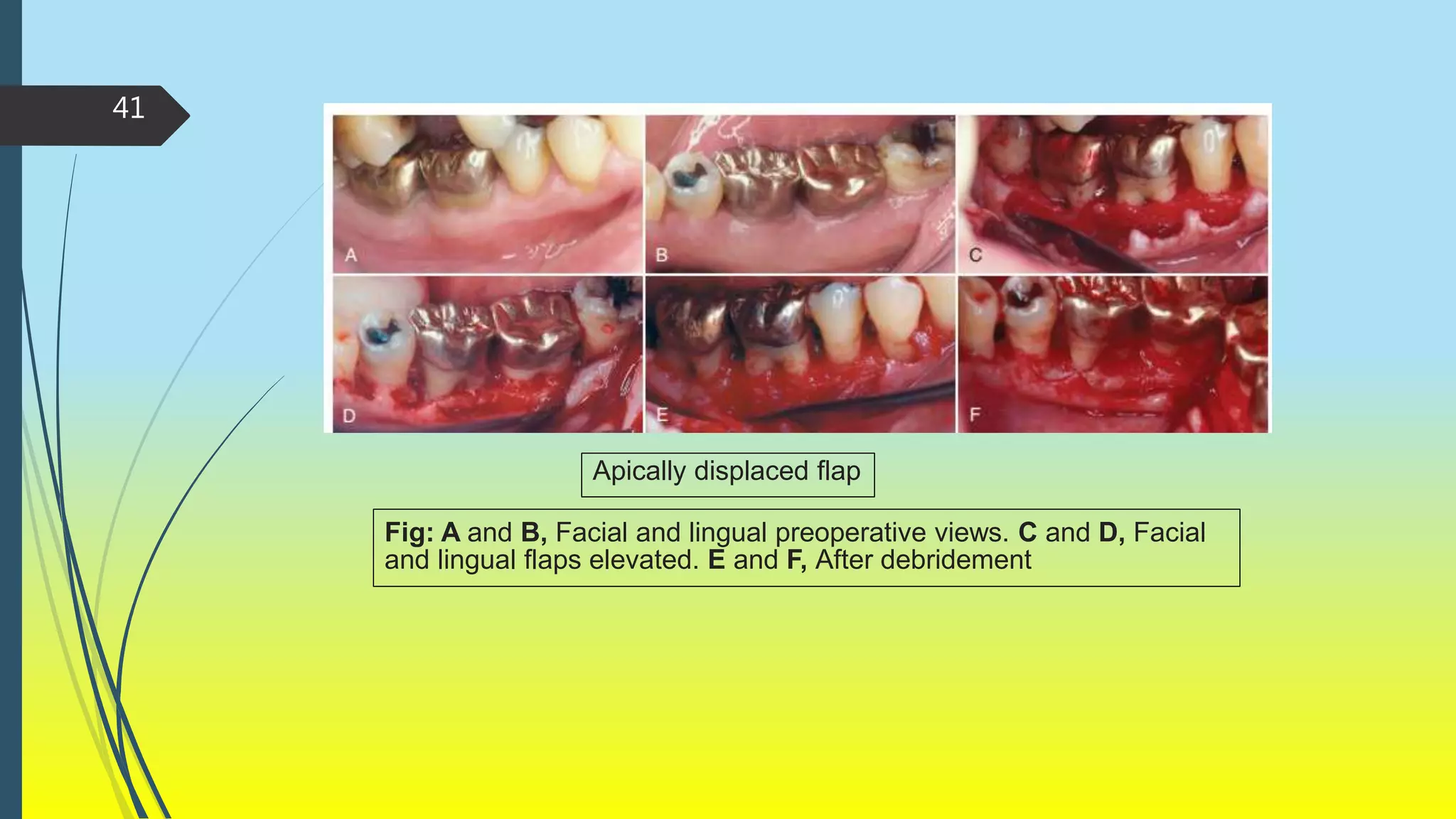 SURGERY TO INCREASE WIDTH OF ATTACHED GINGIVA.pptx