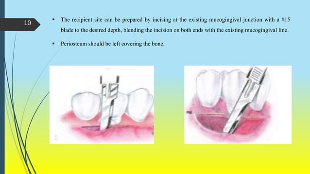 SURGERY TO INCREASE WIDTH OF ATTACHED GINGIVA.pptx
