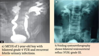 surgery and Vesicourteric reflux disease | PPTX