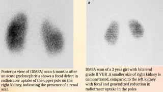 surgery and Vesicourteric reflux disease | PPTX