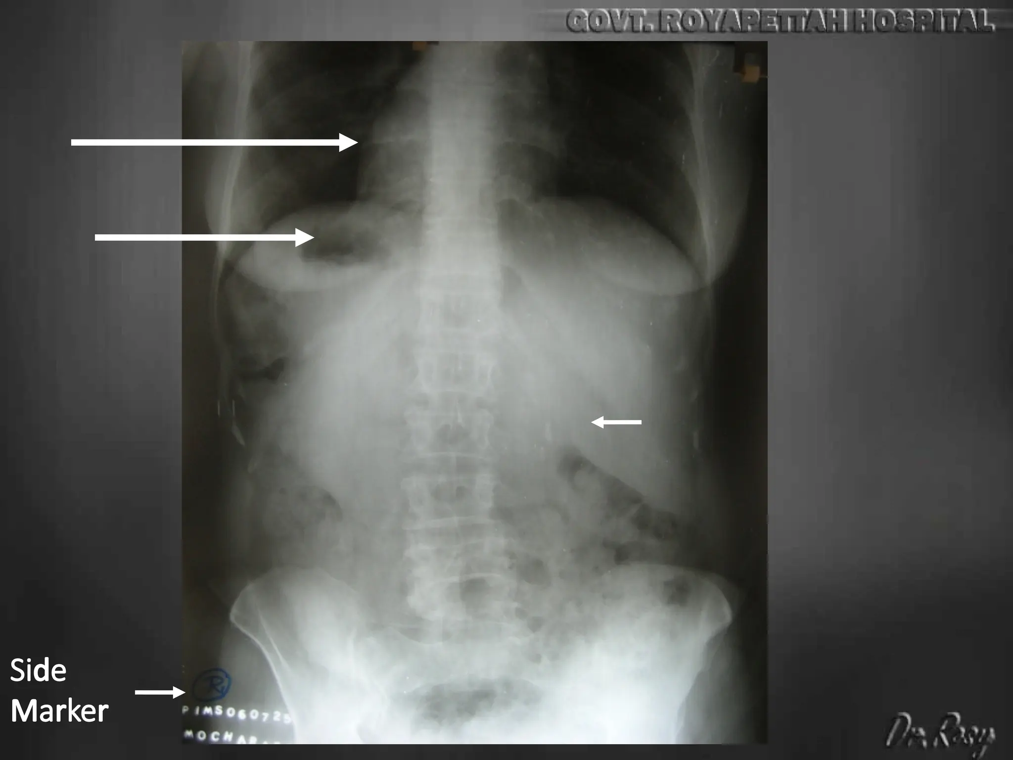 Surgery_XRays basic xray findings in general surgery mbbs.pptx