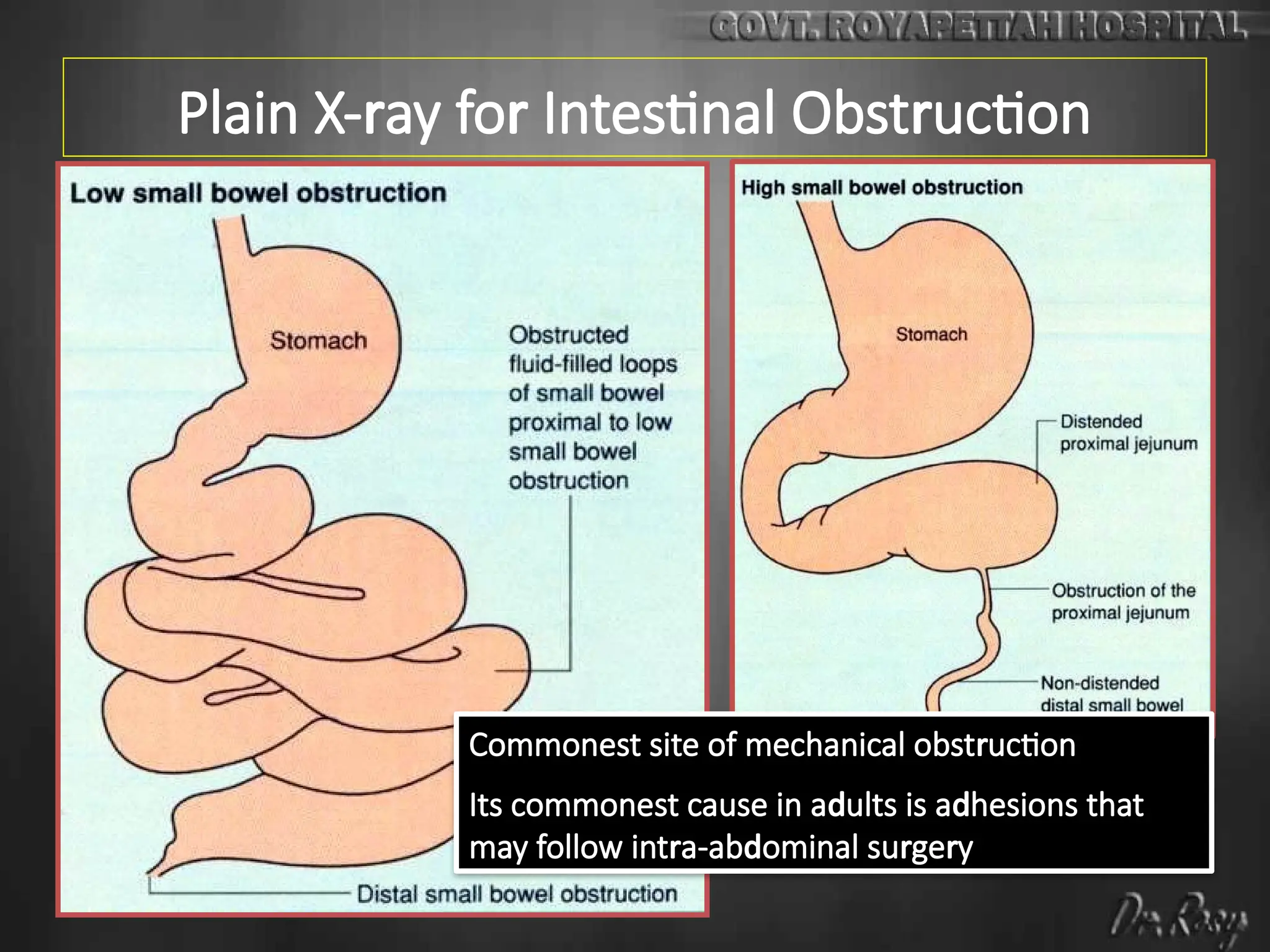 Surgery_XRays basic xray findings in general surgery mbbs.pptx