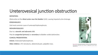 Surgery ppt (1) urinary tract obstruction | PPTX