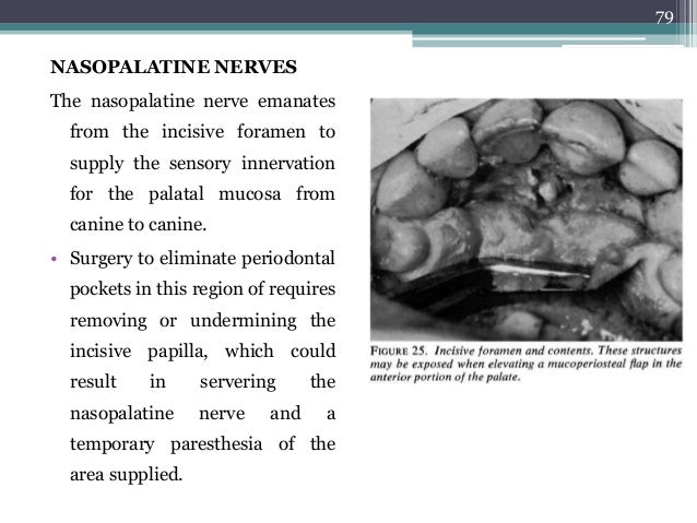 Nasopalatine Nerve Incisive Foramen