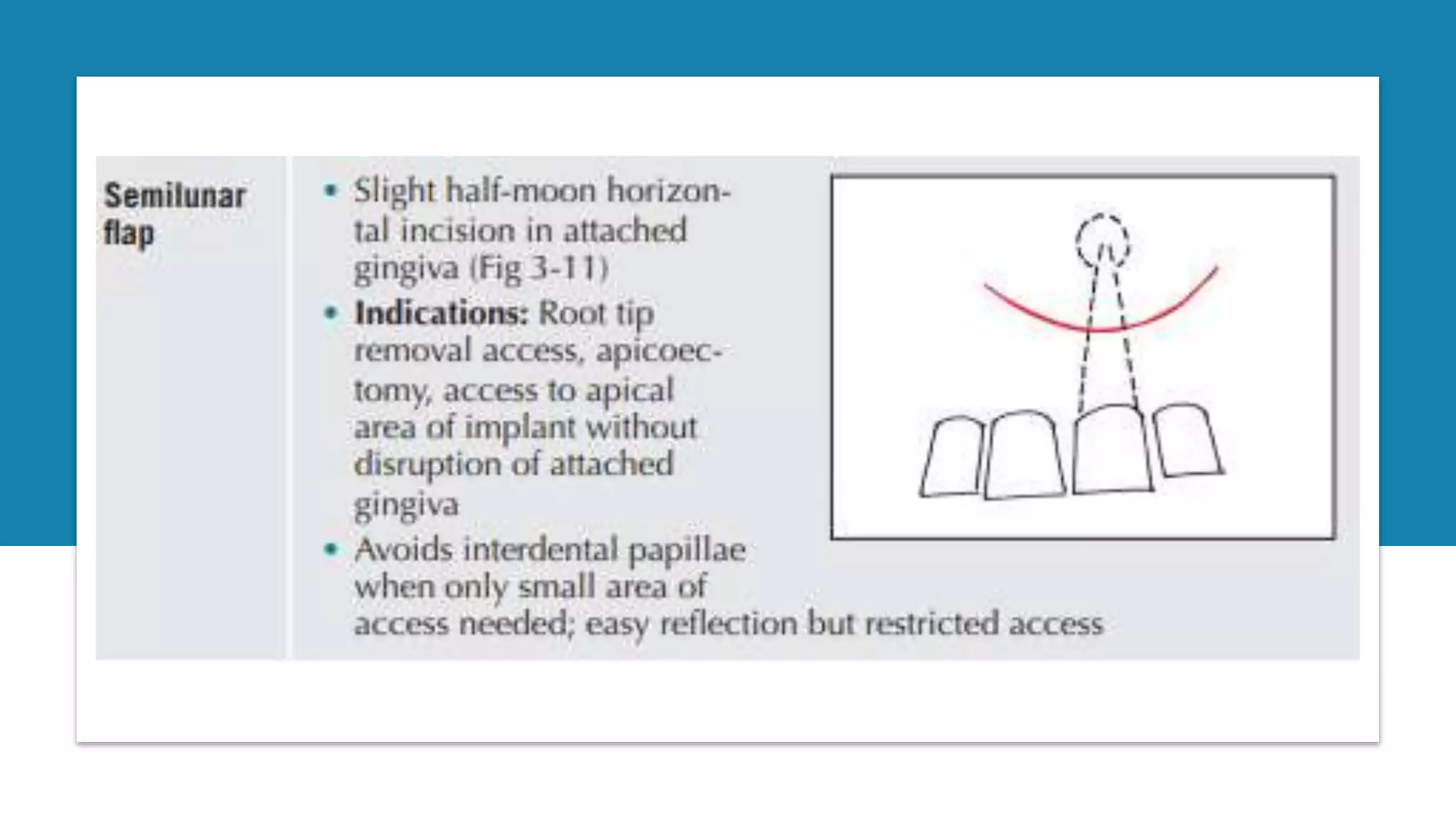 Extraction of retained roots. | PPTX