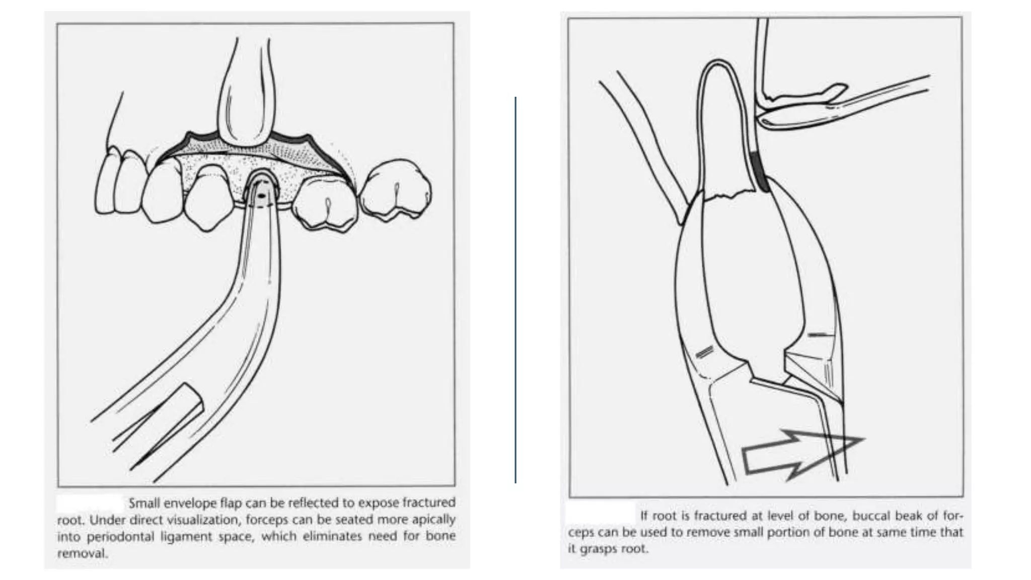 Extraction of retained roots. | PPTX