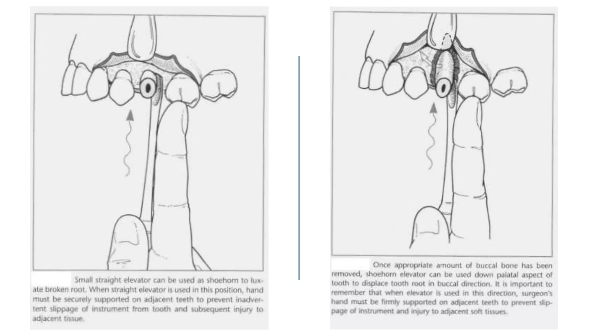 Extraction of retained roots. | PPTX
