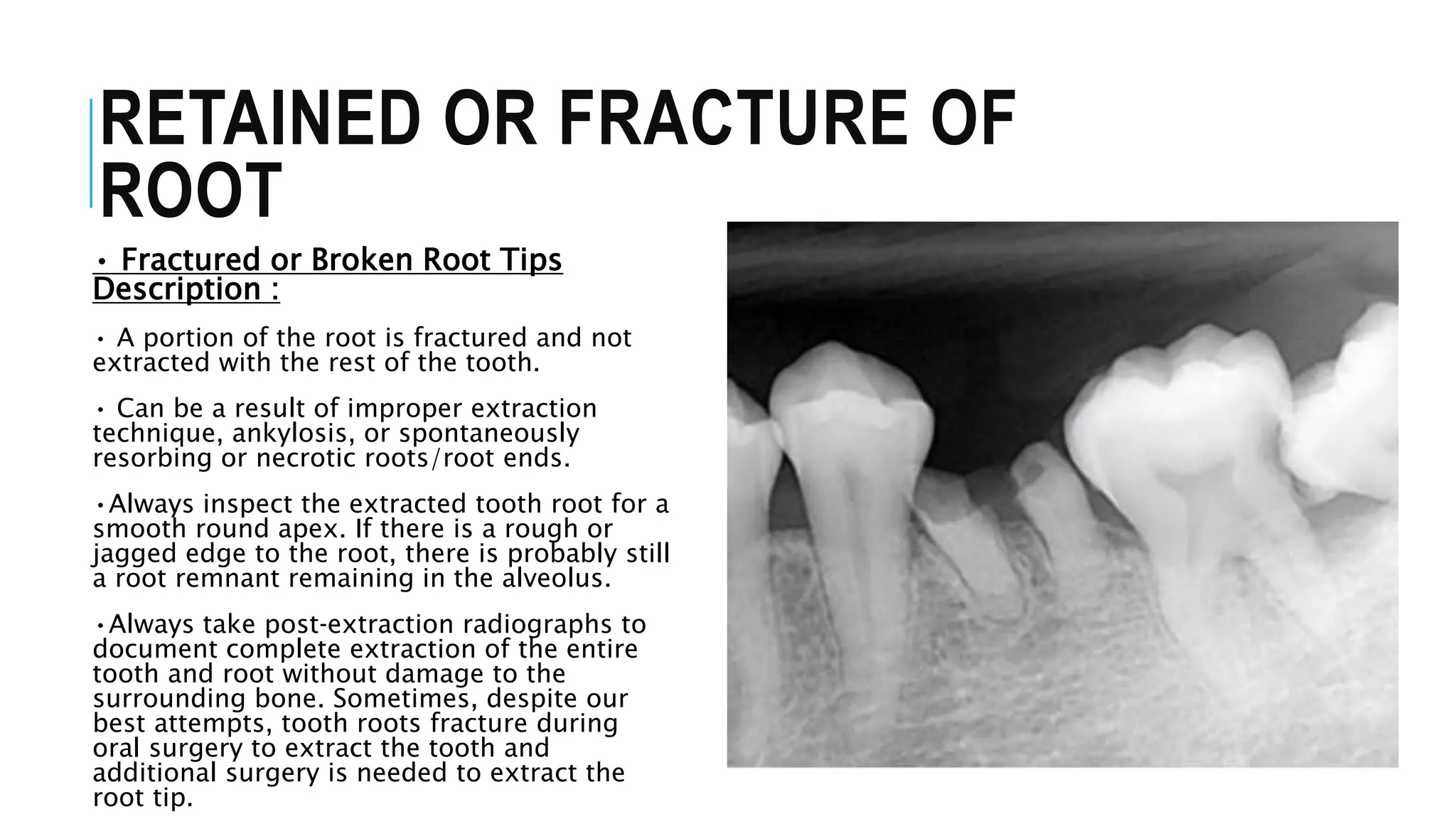 Extraction of retained roots. | PPTX
