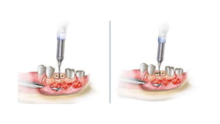 Extraction of retained roots. | PPTX