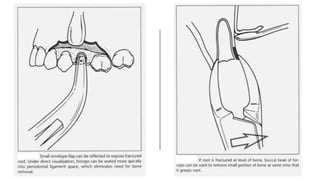 Extraction of retained roots. | PPTX
