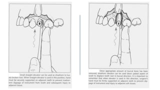 Extraction of retained roots. | PPTX
