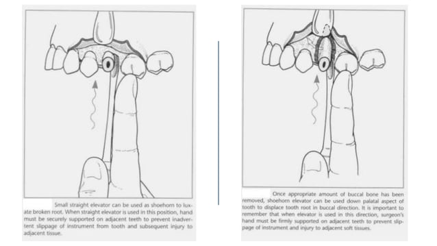 Extraction of retained roots. | PPTX