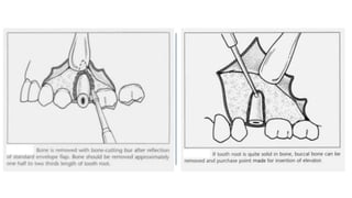 Extraction of retained roots. | PPTX