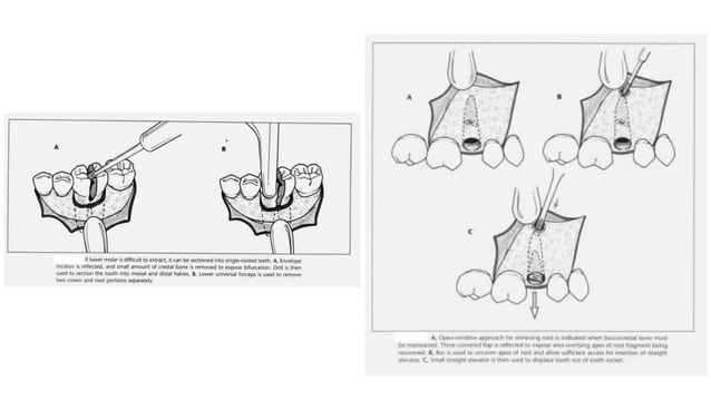 Extraction of retained roots. | PPTX