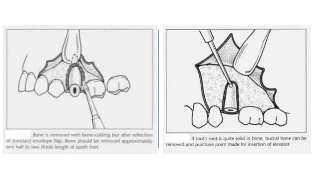Extraction of retained roots.