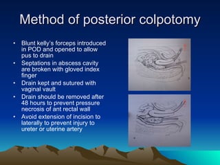 SURGICAL MANAGEMENT OF SEPTIC ABORTION | PPT | Debated Sensitive Social ...