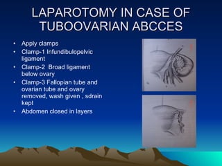 SURGICAL MANAGEMENT OF SEPTIC ABORTION | PPT