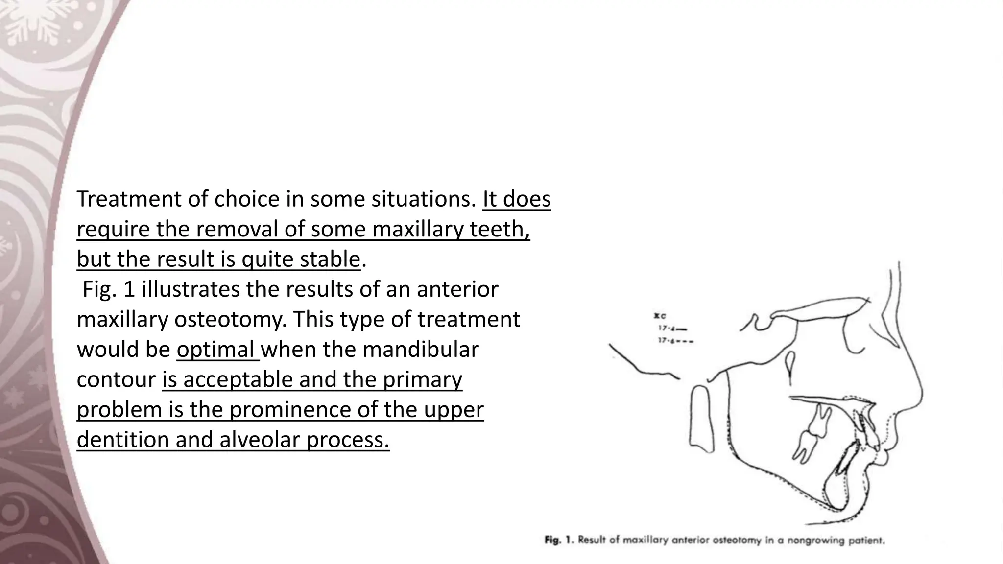 Surgical-Orthodontic Treatment of Severe Mandibular Retrusion.pptx