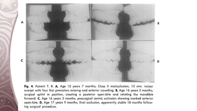 Surgical-Orthodontic Treatment of Severe Mandibular Retrusion.pptx ...