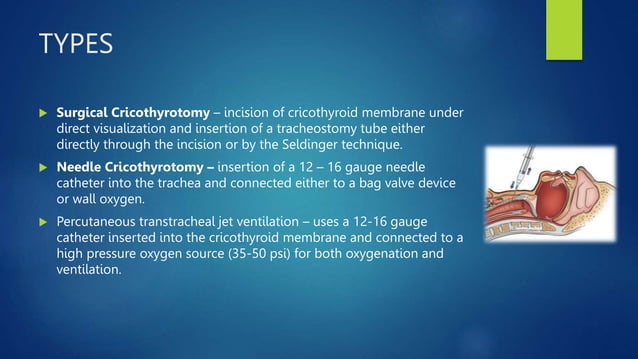 Surgicalairwayand cricothyroidotomy.pptx | Thyroid Disorders ...