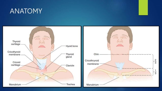 Surgicalairwayand cricothyroidotomy.pptx | Thyroid Disorders ...