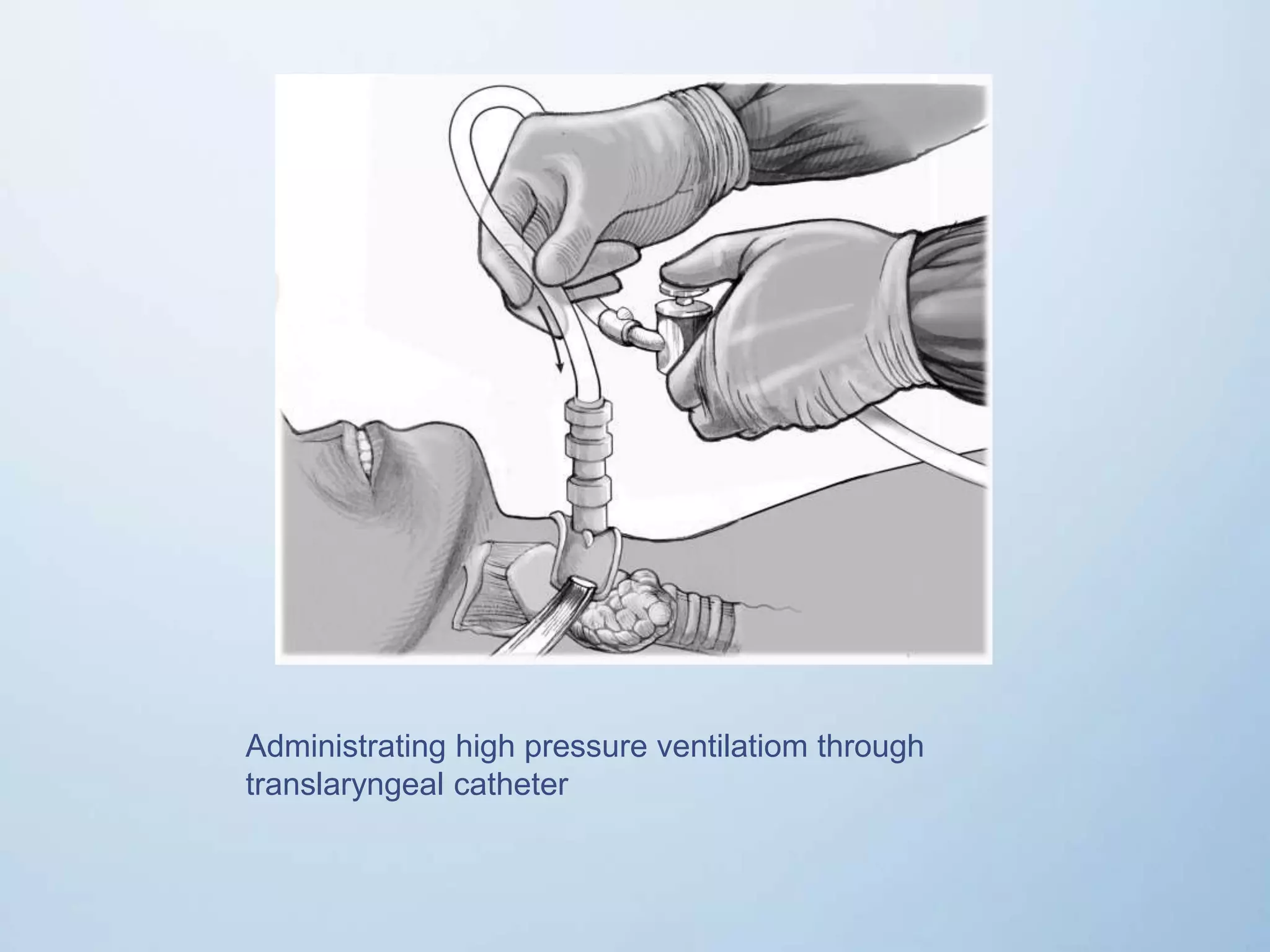 Surgical Airway Management - Tracheostomy,Cricothyroidectomy | PPTX