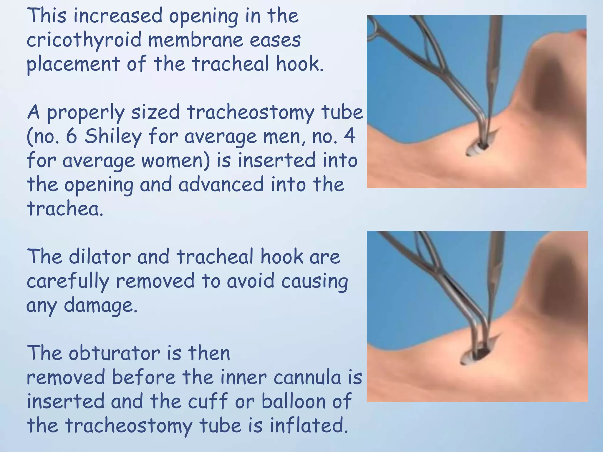 Surgical Airway Management - Tracheostomy,Cricothyroidectomy | PPTX