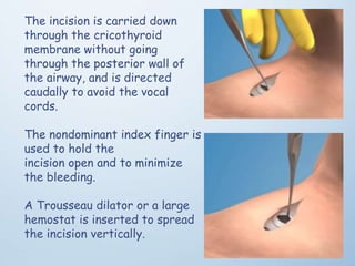 Cricothyroid Membrane Incision