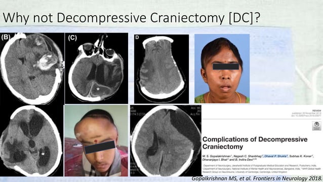 Surgical alternatives to decompressive craniectomy for TBI and stroke.pptx