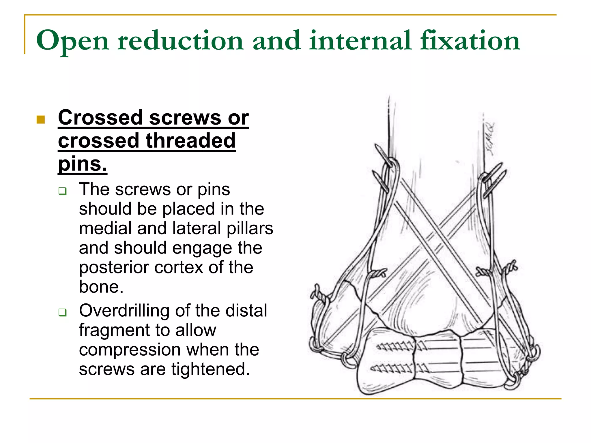 anatomy of elbow & fractures around elbow & surgical options in adults ...