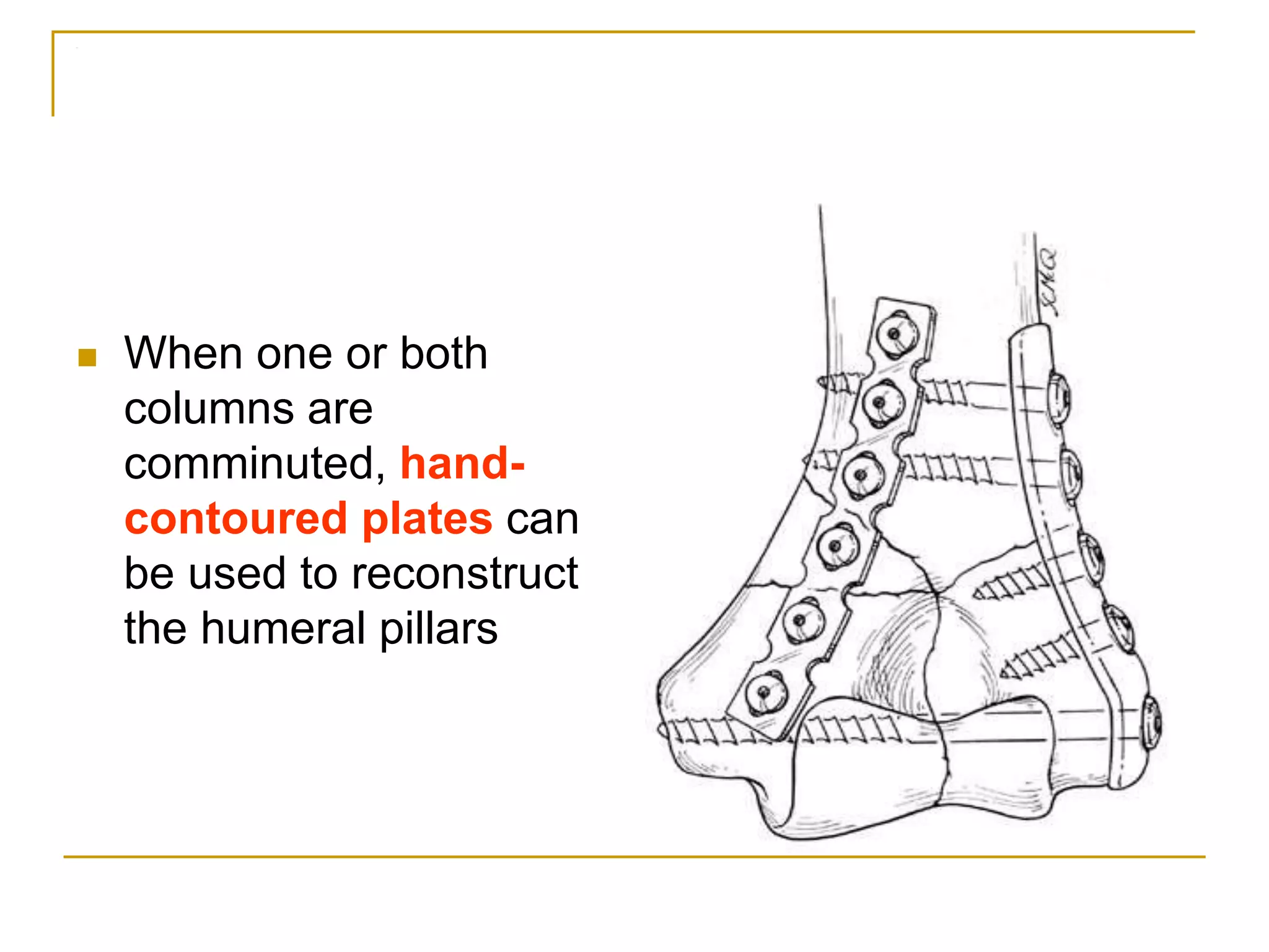 anatomy of elbow & fractures around elbow & surgical options in adults ...