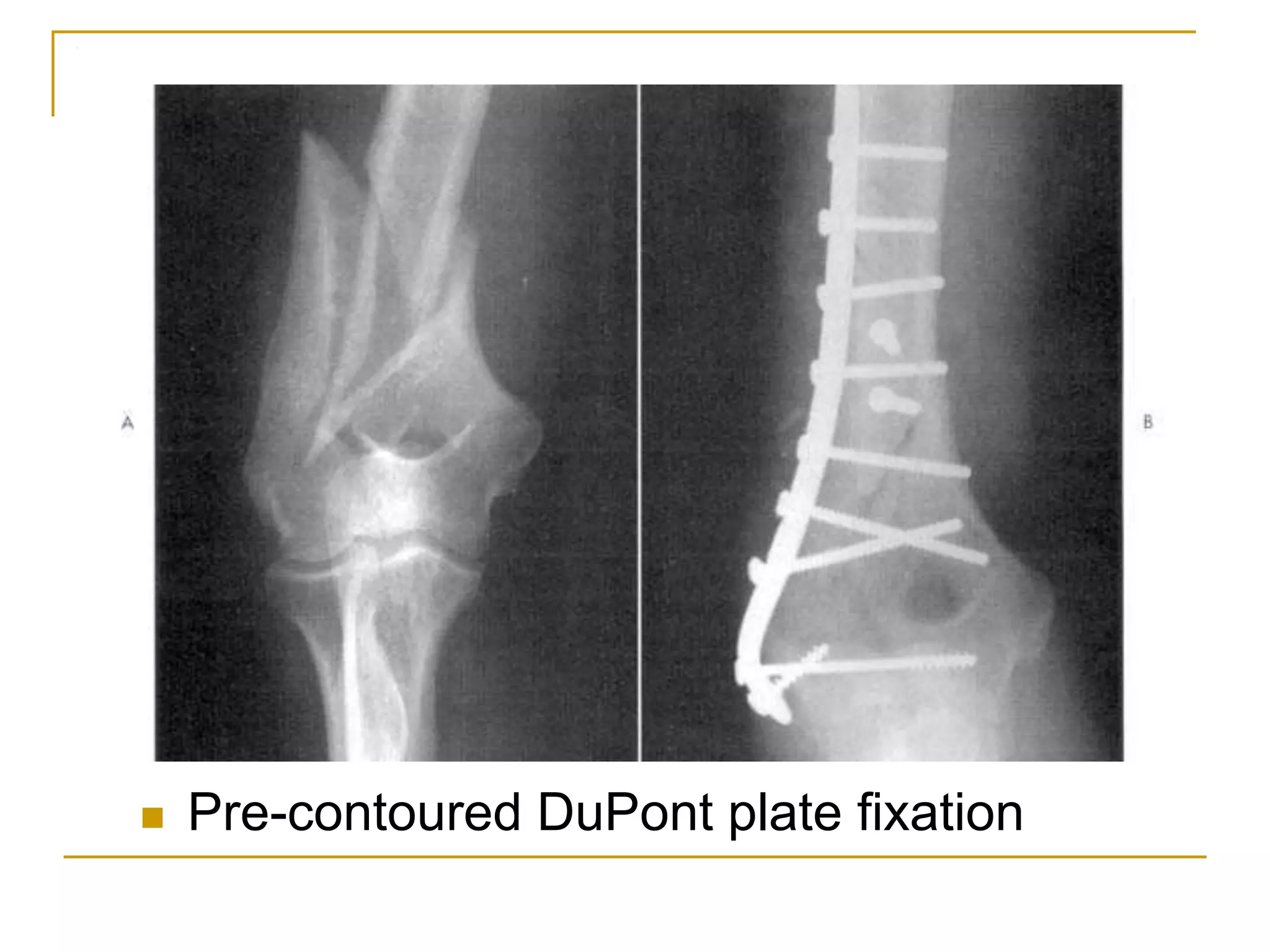 anatomy of elbow & fractures around elbow & surgical options in adults ...
