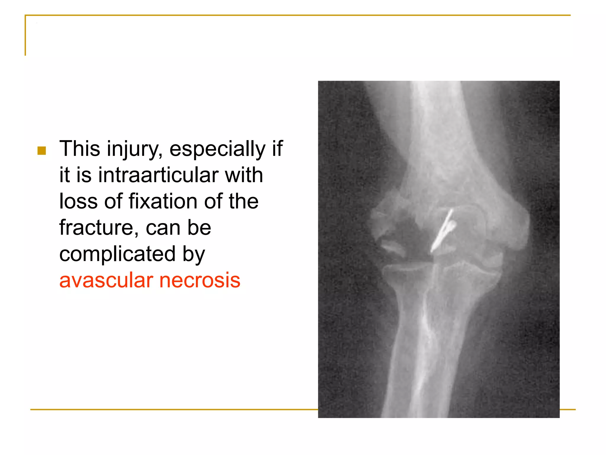 anatomy of elbow & fractures around elbow & surgical options in adults ...