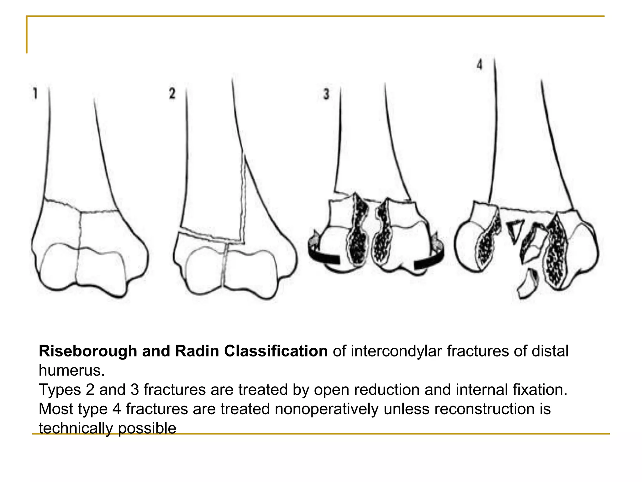 anatomy of elbow & fractures around elbow & surgical options in adults ...