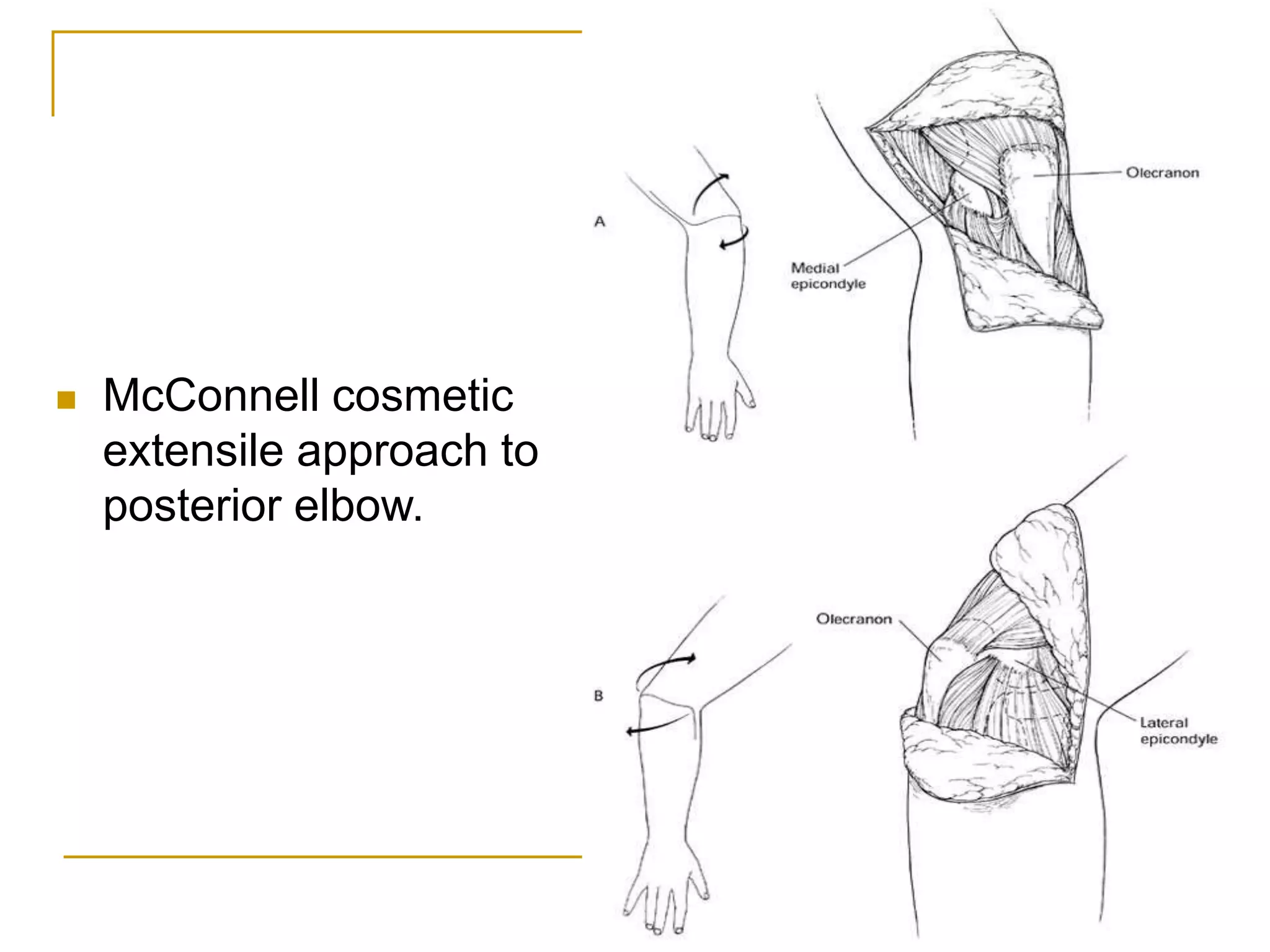 Anatomy Of Elbow And Fractures Around Elbow And Surgical Options In Adults Ppt