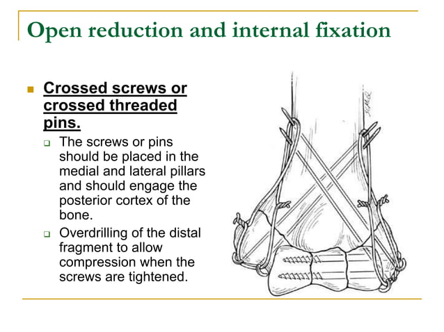 anatomy of elbow & fractures around elbow & surgical options in adults ...